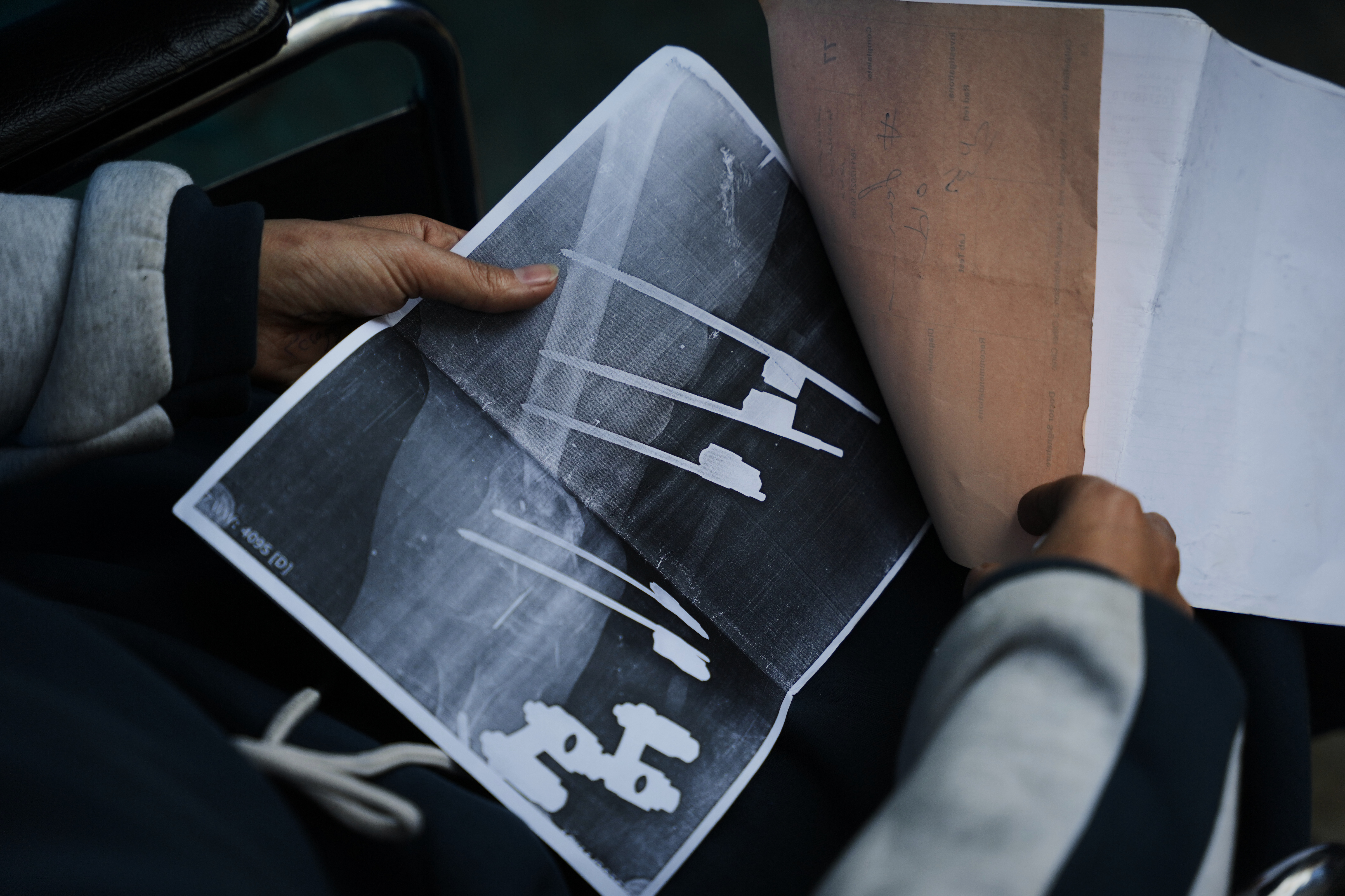 A bullet shattered her knee. Now a Gaza teen's chances of walking ...